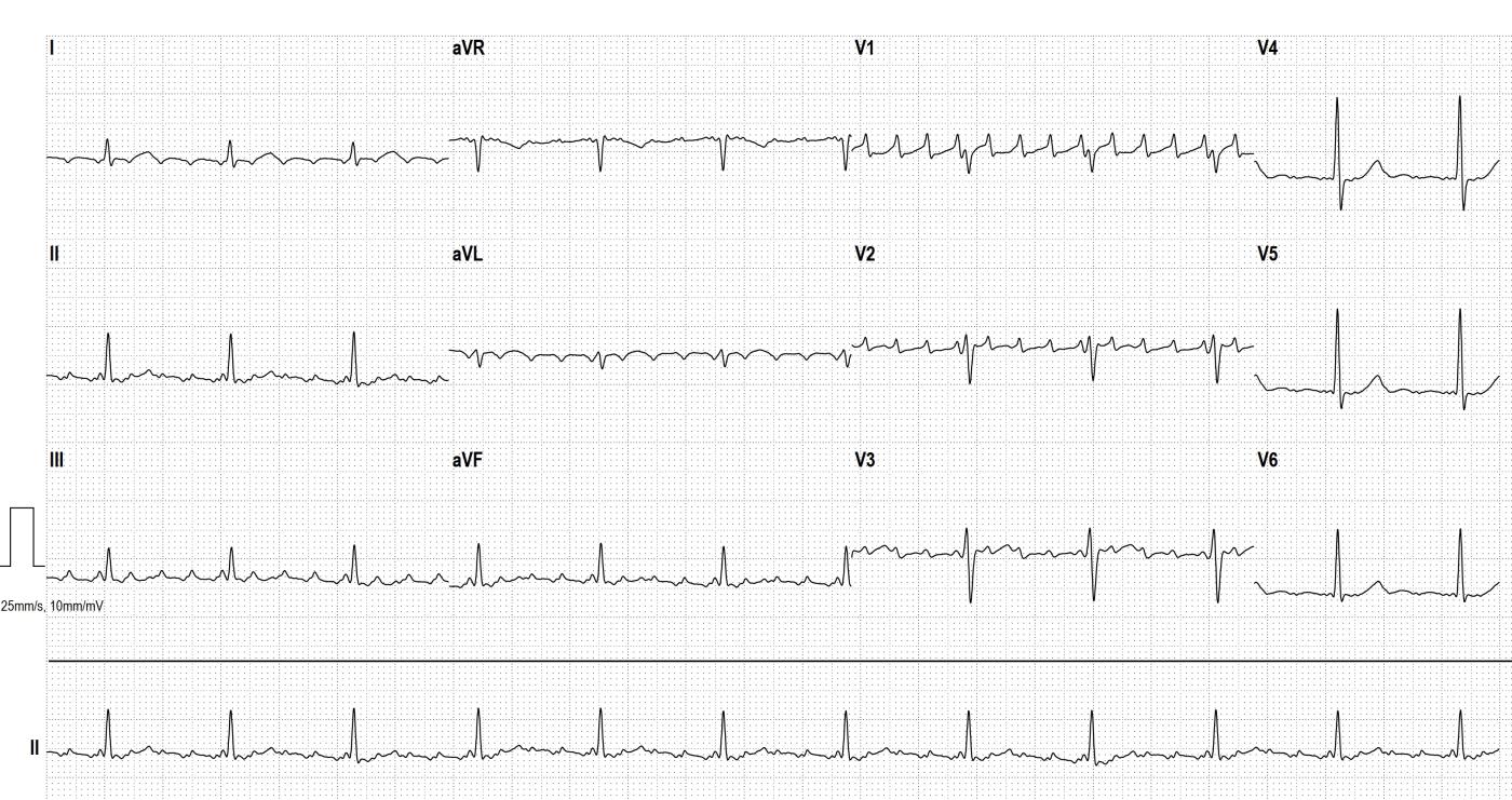 Atypical Atrial Flutter From The Left Atrium Ecg Guru Instructor Resources